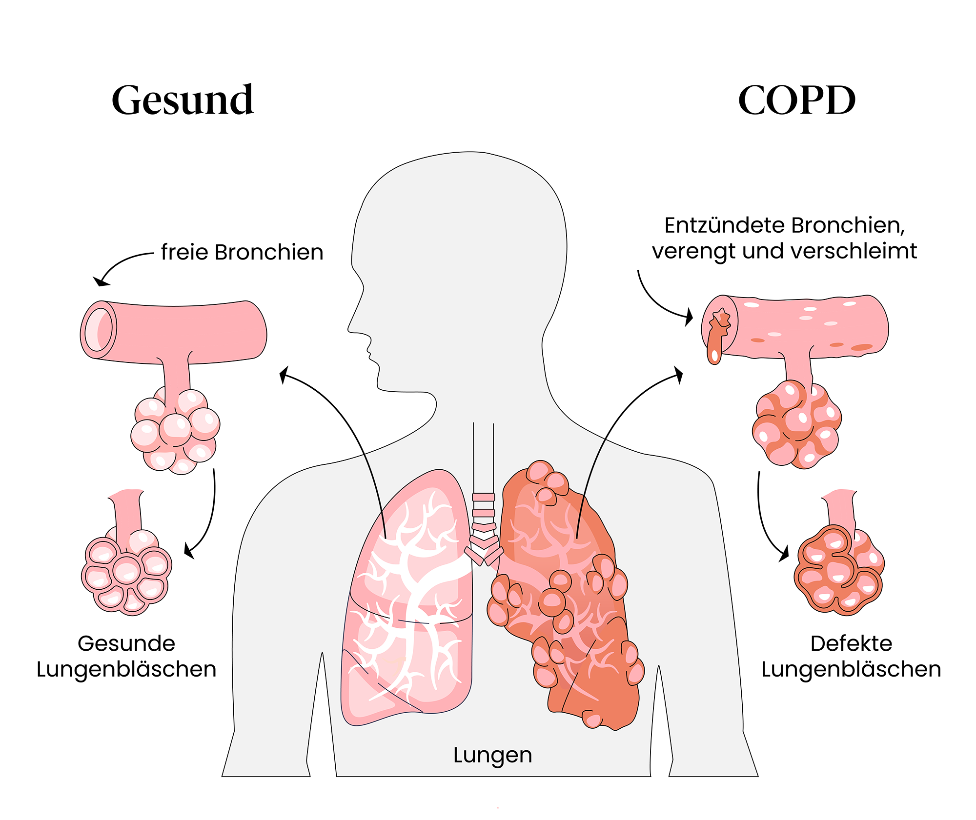 COPD | Zur Rose